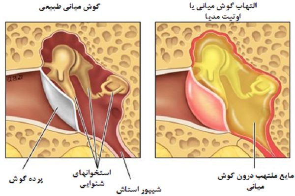 8 علائم عفونت گوش کودک یا اوتیت مدیا کودک گهواره
